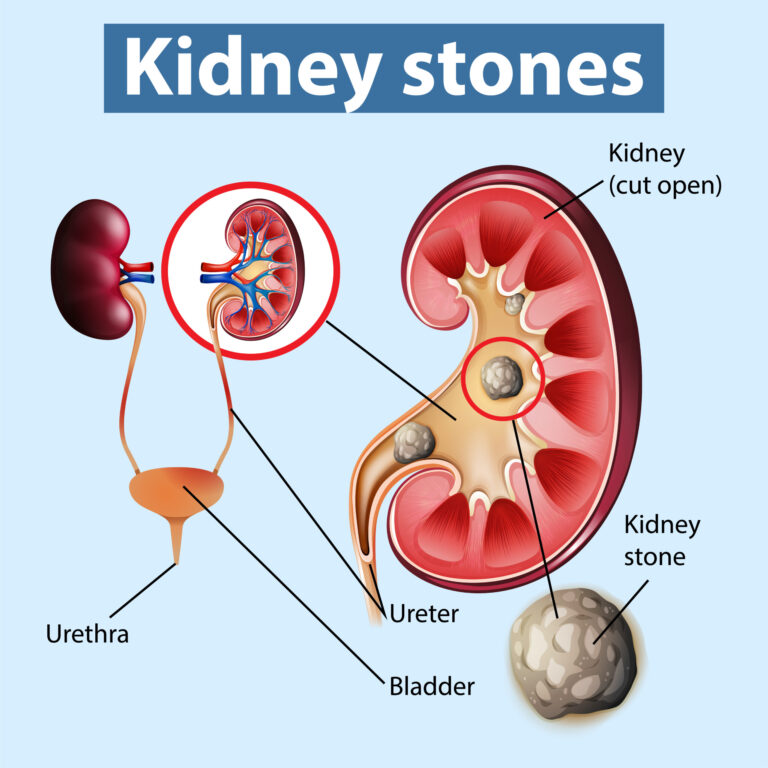 Understanding Ureteroscopy (URS): A Key Treatment in Urology - Dr Sanket